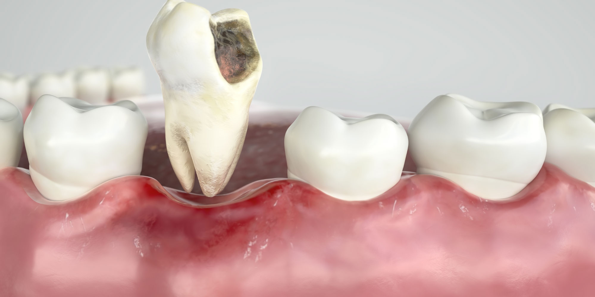 Tooth Extractions | Albuquerque, NM | Precision Dental Care